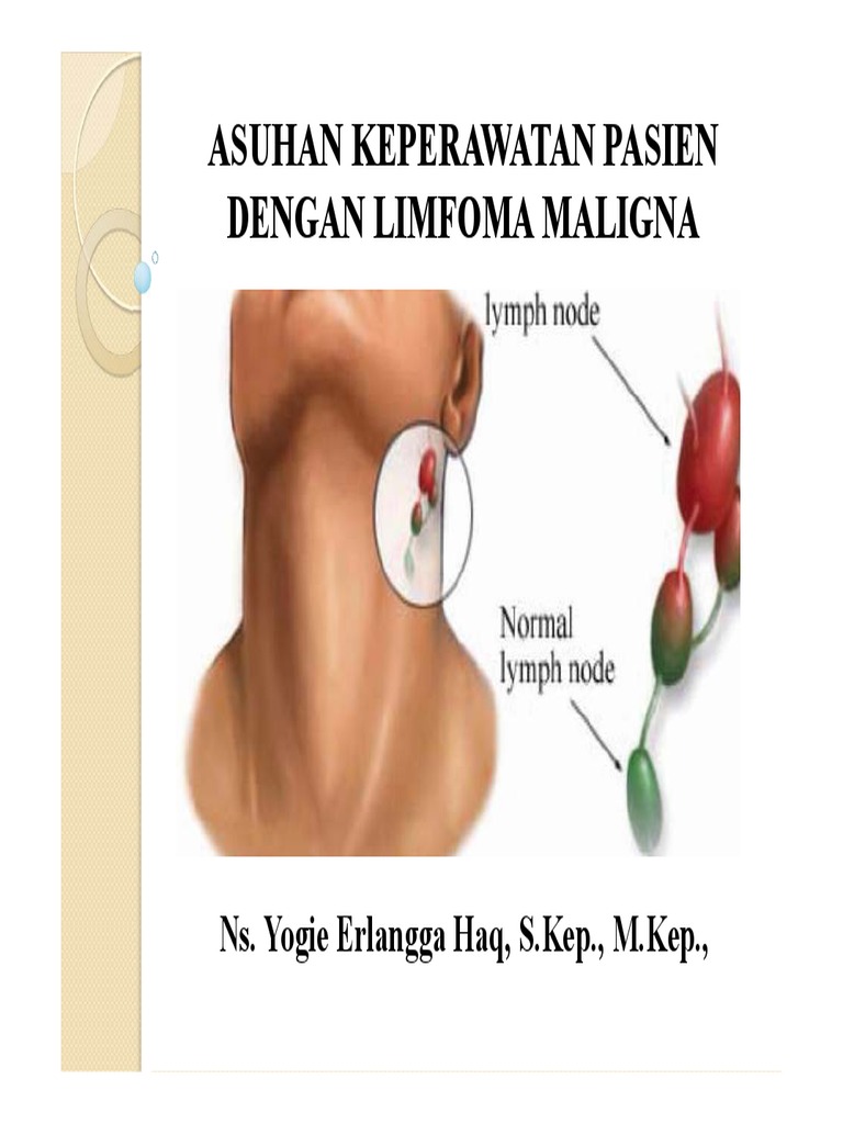 Askep Limfoma Maligna - Yogie | PDF