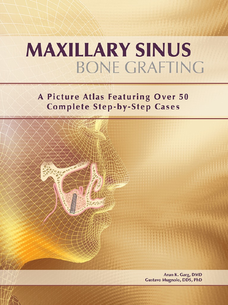 Maxillary Sinus Bone Grafting | PDF | Bone | Osteoblast