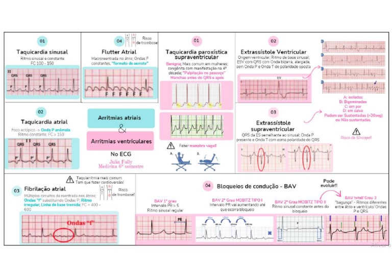 Mapa Mental - Arritmia Cardíaca | PDF