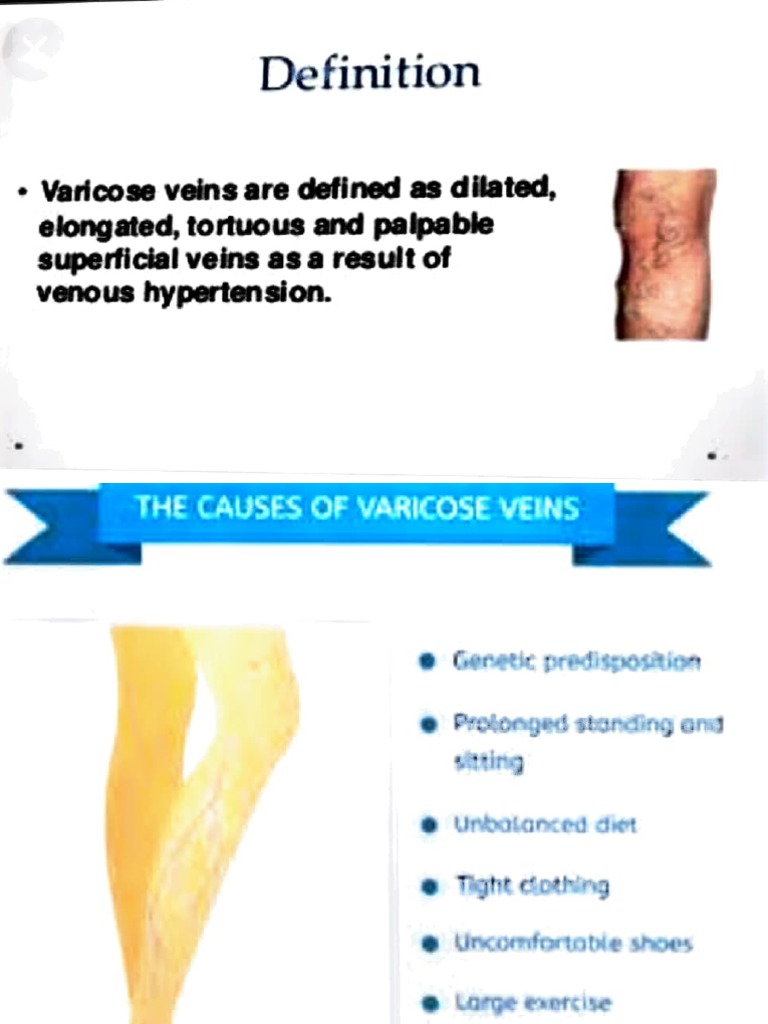 Varicose Veins | Download Free PDF | Varicose Veins | Vein