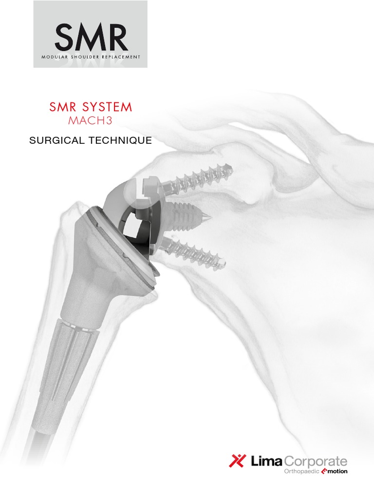 SMR - Mach 3 - Completo | PDF | Shoulder | Surgery