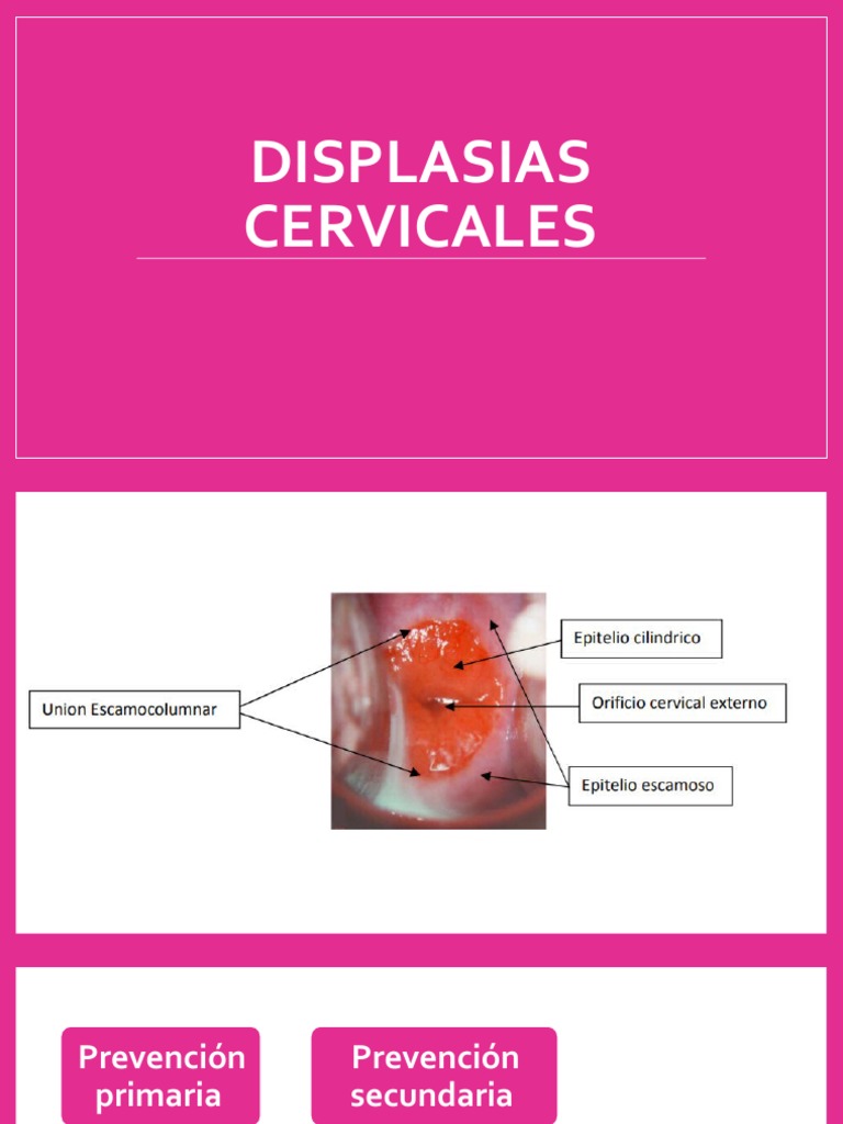 Displasias Cervicales | PDF | Cáncer de cuello uterino | Medicina CLINICA