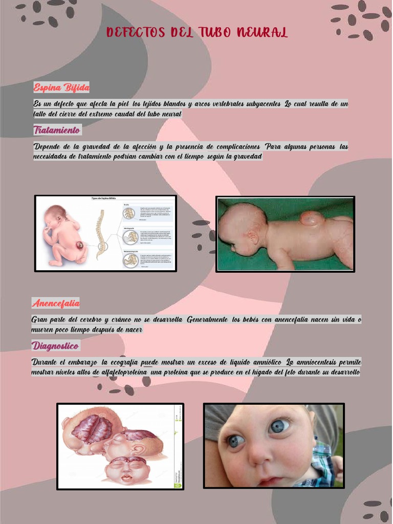 Infografia Defectos Del Tubo Neural | PDF