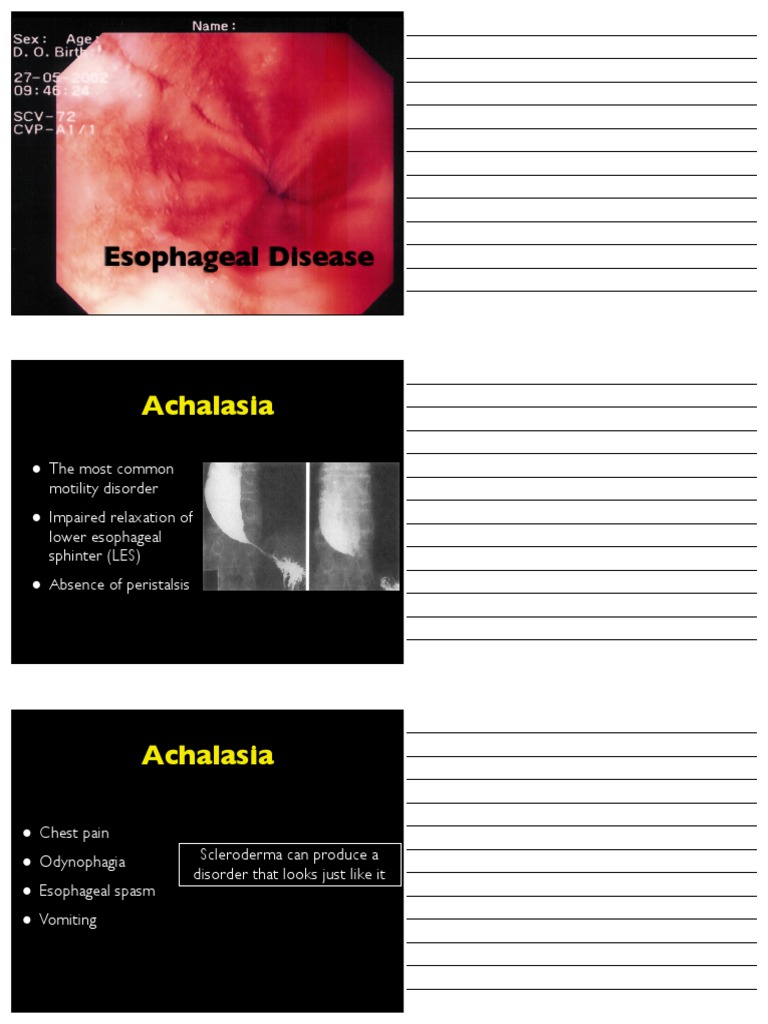Esophagus & Stomach Slides | PDF | Esophagus | Gastroesophageal Reflux ...
