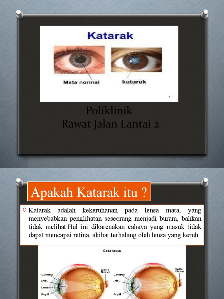 Katarak Poli | PDF
