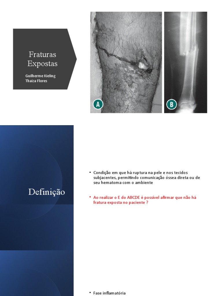 Fraturas Expostas 1 | PDF | Infecção | Medicina Clínica