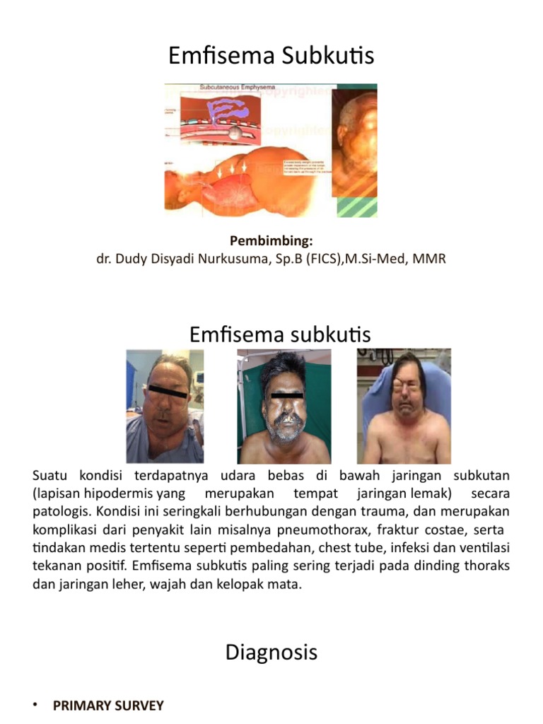 EMFISEMA SUBKUTIS | PDF