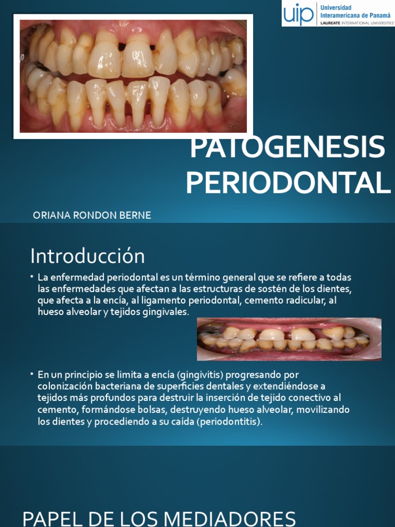 2. Patogénesis Periodontal 2 | PDF | Sistema inmune | Citocina