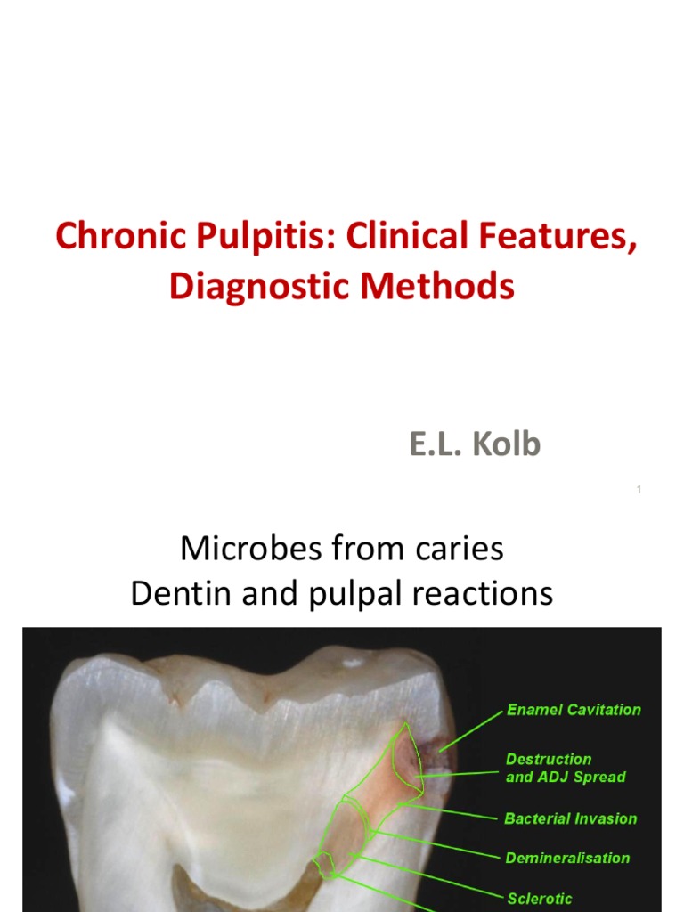 Lecture - 6-3 - Chronic Pulpitis. Clinical Features, Diagnostic Methods ...