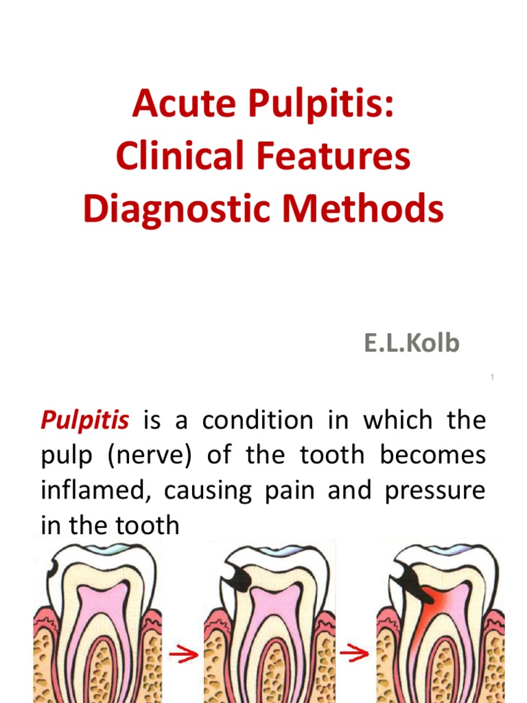 Lecture - 6-2 - Acute Pulpitis. Clinical Features, Diagnostic Methods ...