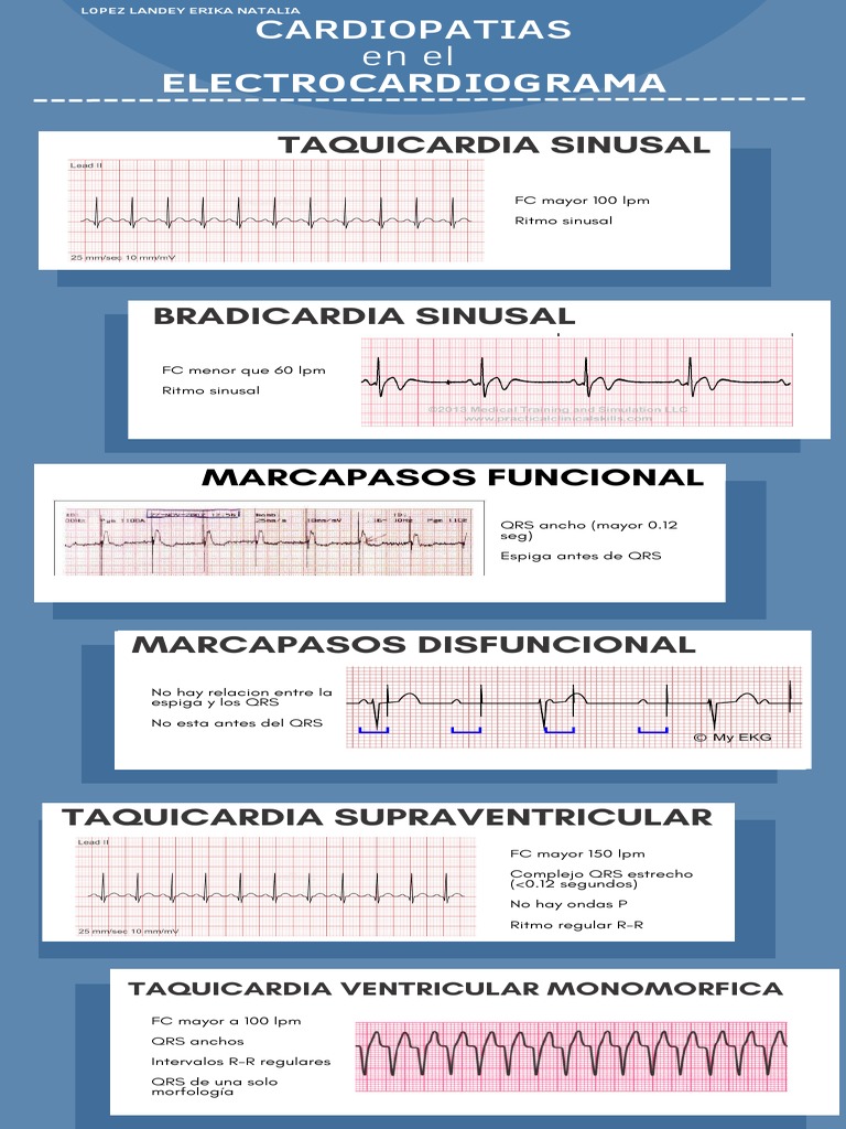 Ekg Patologico | PDF | Electrocardiografia | Medicina CLINICA