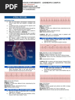 Atrial Fibrillation:Flutter in Pre-Excitation - LITFL - ECG Library ...