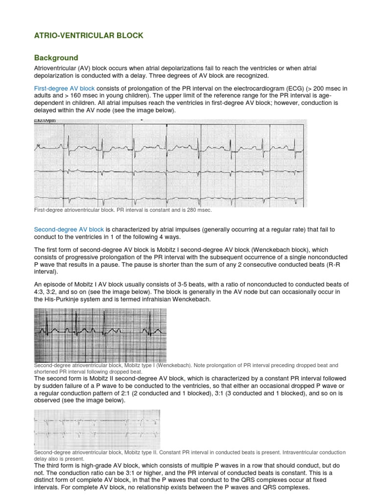 Av Block | Download Free PDF | Artificial Cardiac Pacemaker ...