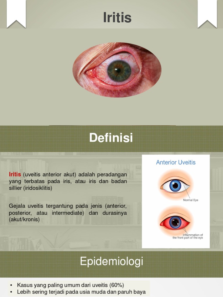 Iritis: Gejala dan Tatalaksana | PDF