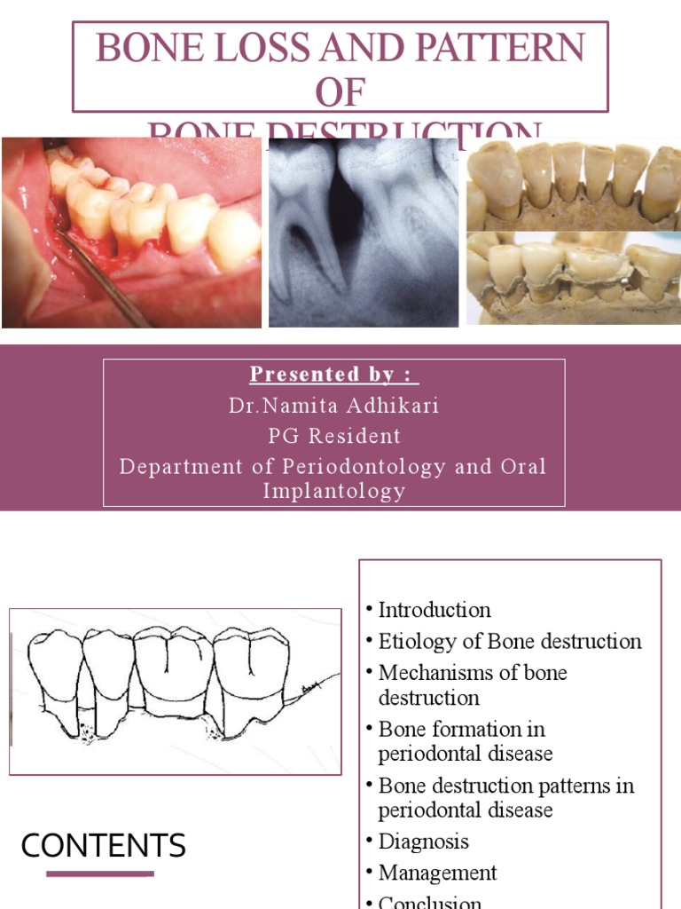Bone Loss | PDF
