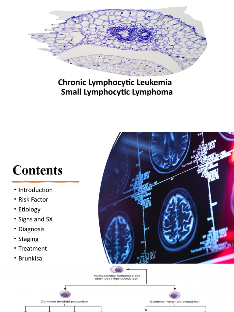 CLL SLL | PDF | Lymphocyte | Cancer