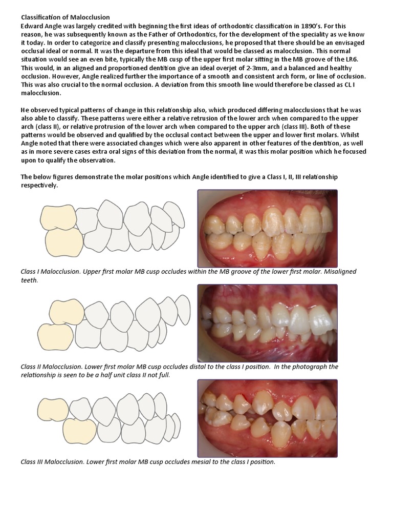 Types Of Malocclusion Of Teeth
