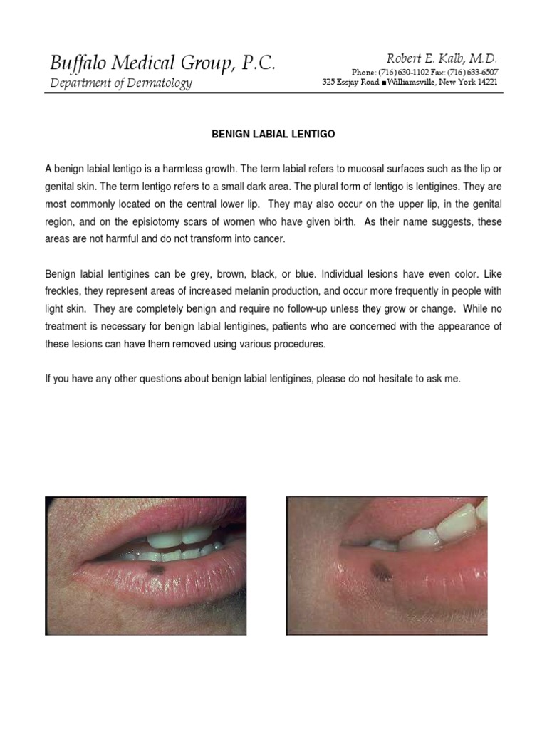 Benign-Labial-Lentigo | PDF