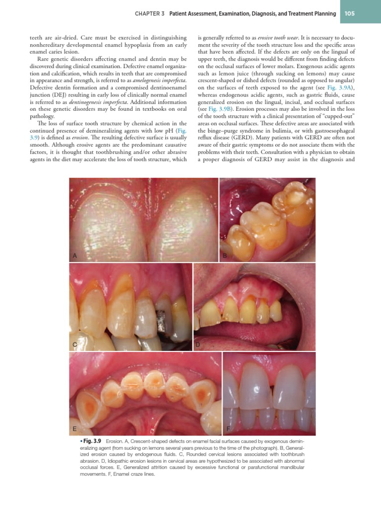 Sturdevant's Bab 3 11-20 | PDF | Periodontology | Dental Anatomy