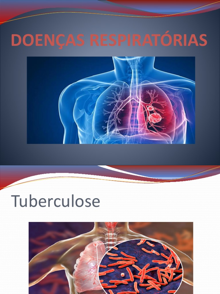 Tuberculose: Sintomas e Tratamento | PDF | Tuberculose | Pneumonia