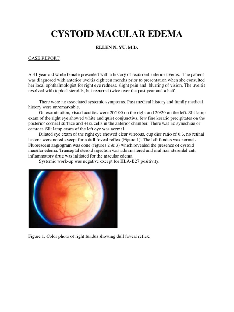 Cystoid Macular Edema Case Study | PDF | Retina | Inflammation