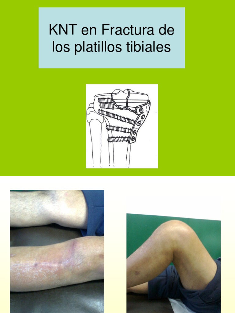KNT en FR Platillos Tibiales | PDF | Rodilla | Tobillo