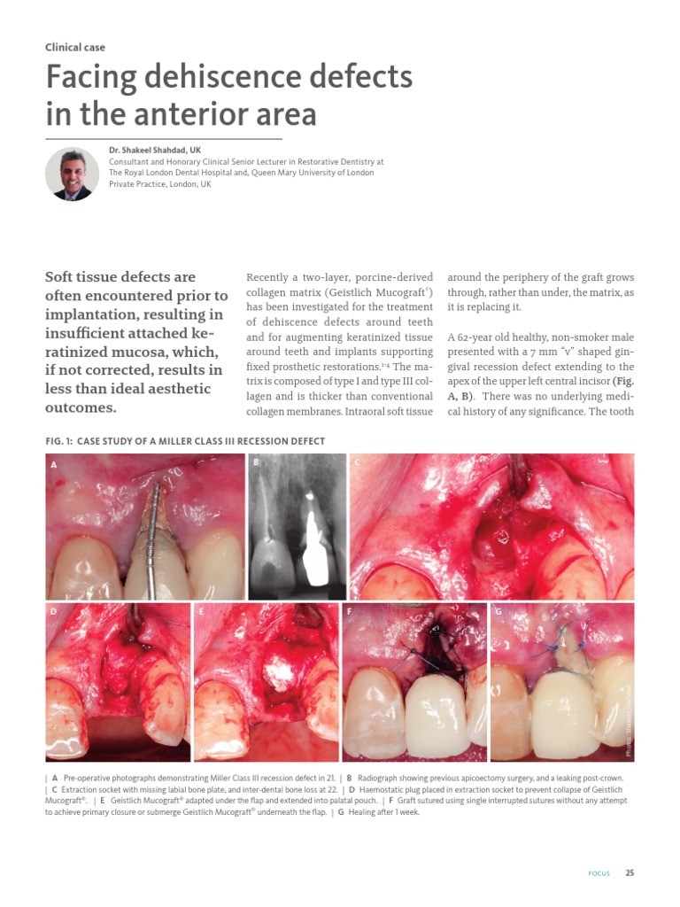 Aesthetic Zone Shakeel Shahdad | PDF | Dental Implant | Dentistry Branches
