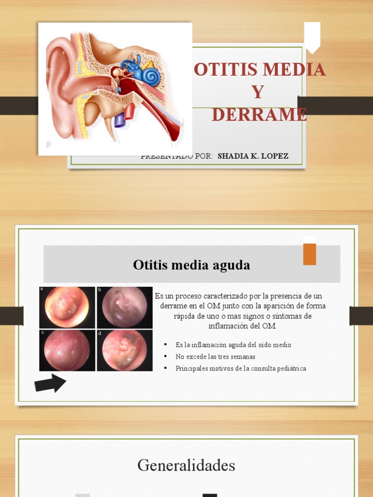Otitis Media Aguda | PDF | Síntoma | Salud pública