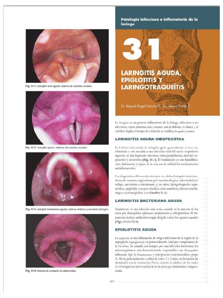 Laringitis Aguda | PDF