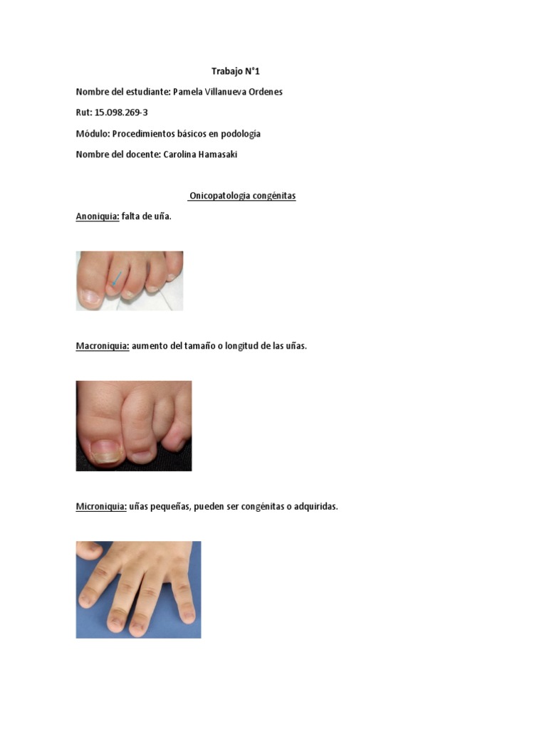 Onicopatologías: Tipos y Características | PDF | Clavo (anatomía ...