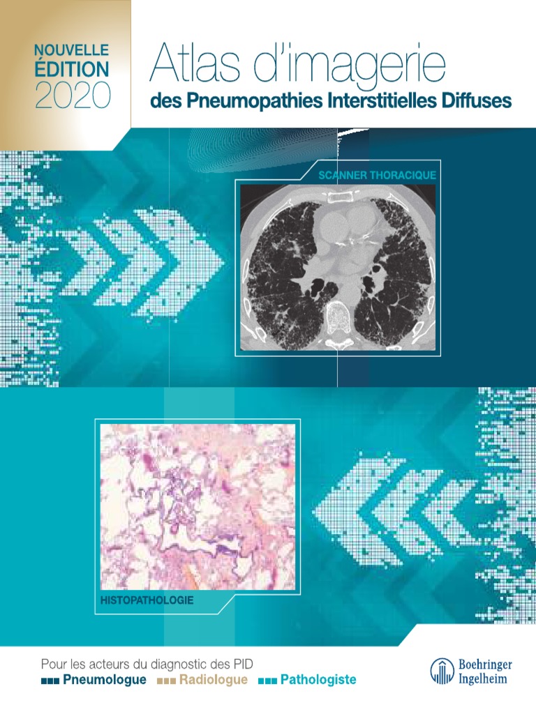 Atlas D'imagerie Des Pneumopathies Interstitielles Diffuses | PDF