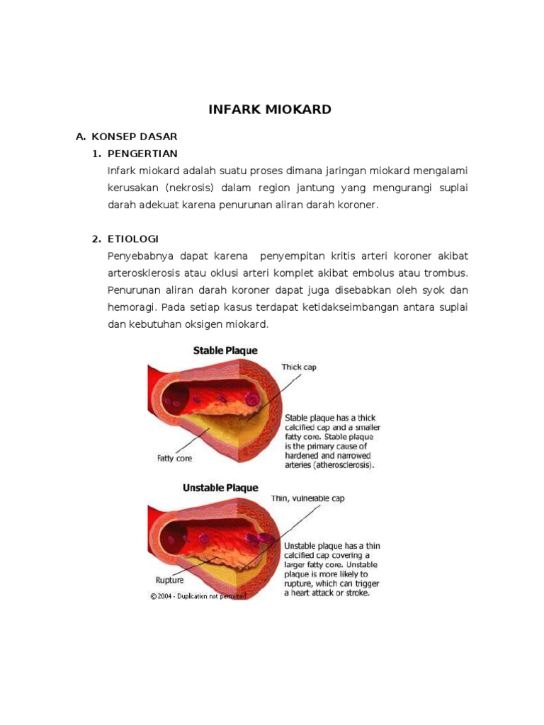 Infark Miokardium | PDF