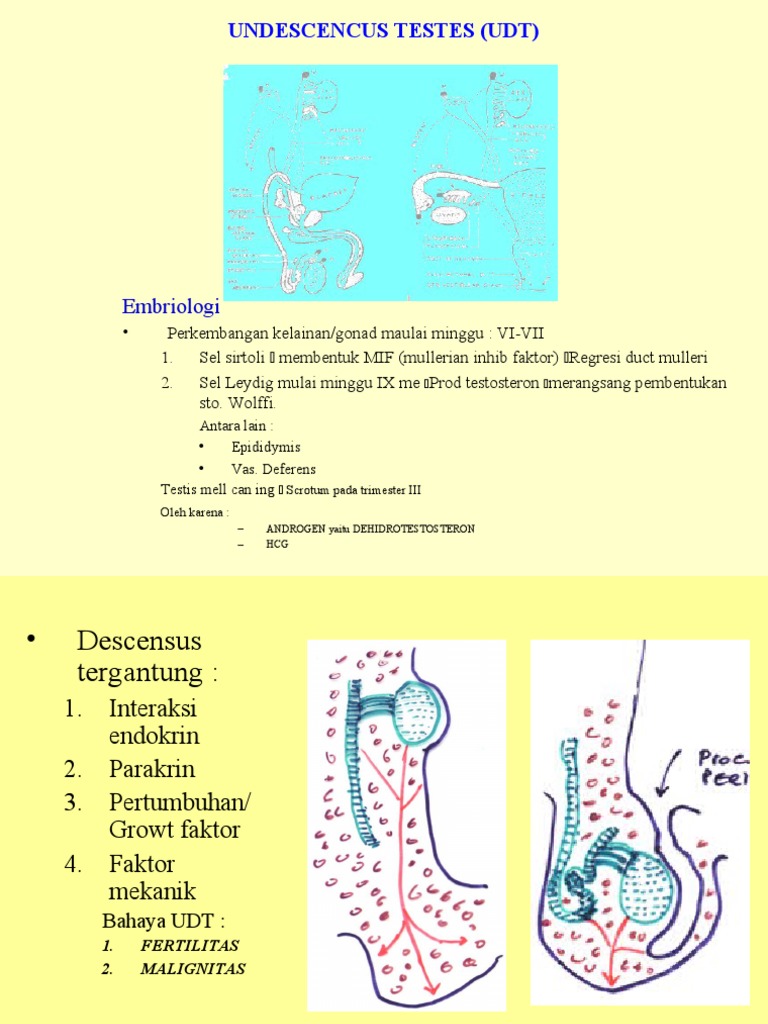Penanganan Undescended Testis (UDT) | PDF