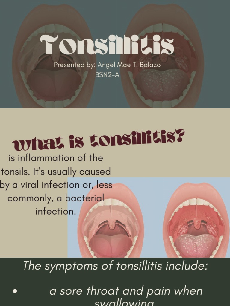 Tonsillitis Overview and Complications | PDF | Human Nose | Immunology