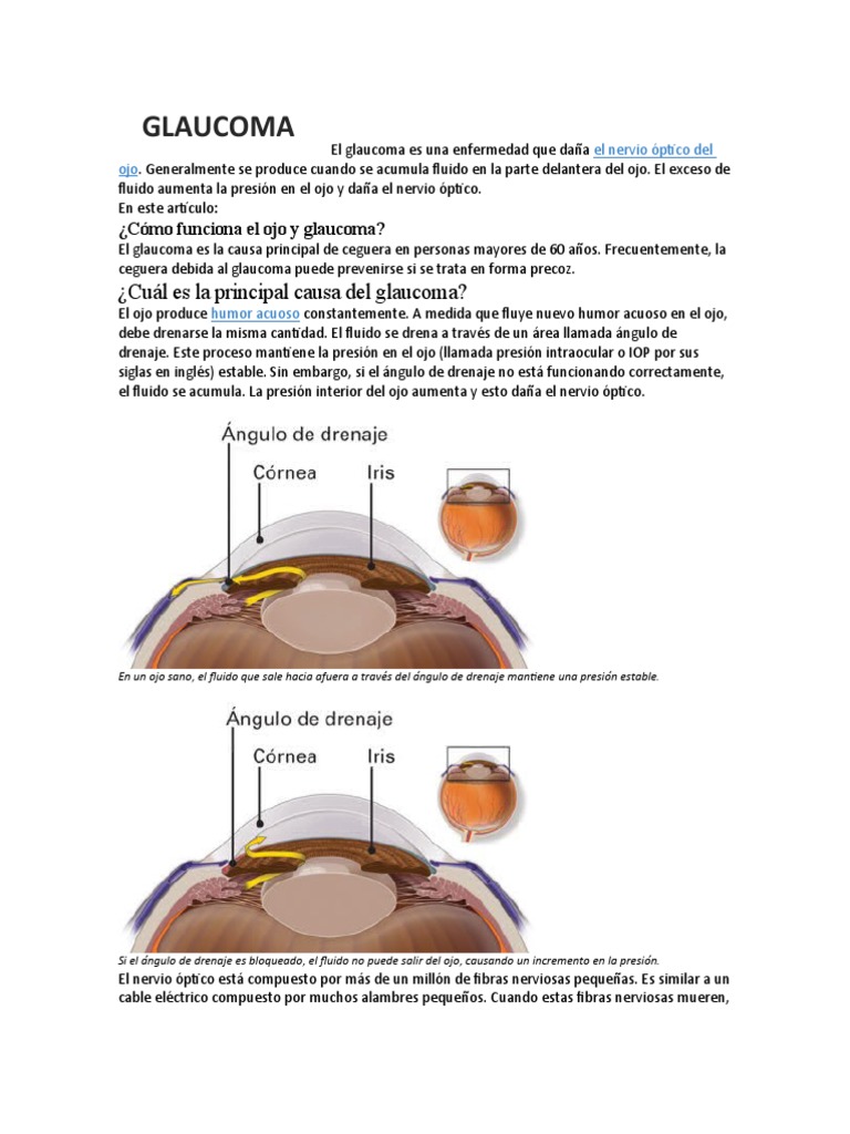 GLAUCOMA | PDF | Glaucoma | Ojo humano