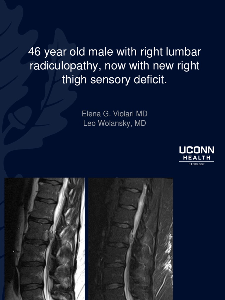 EV 4 NEURO MR Disc Sequestration | PDF | Neurological Disorders ...