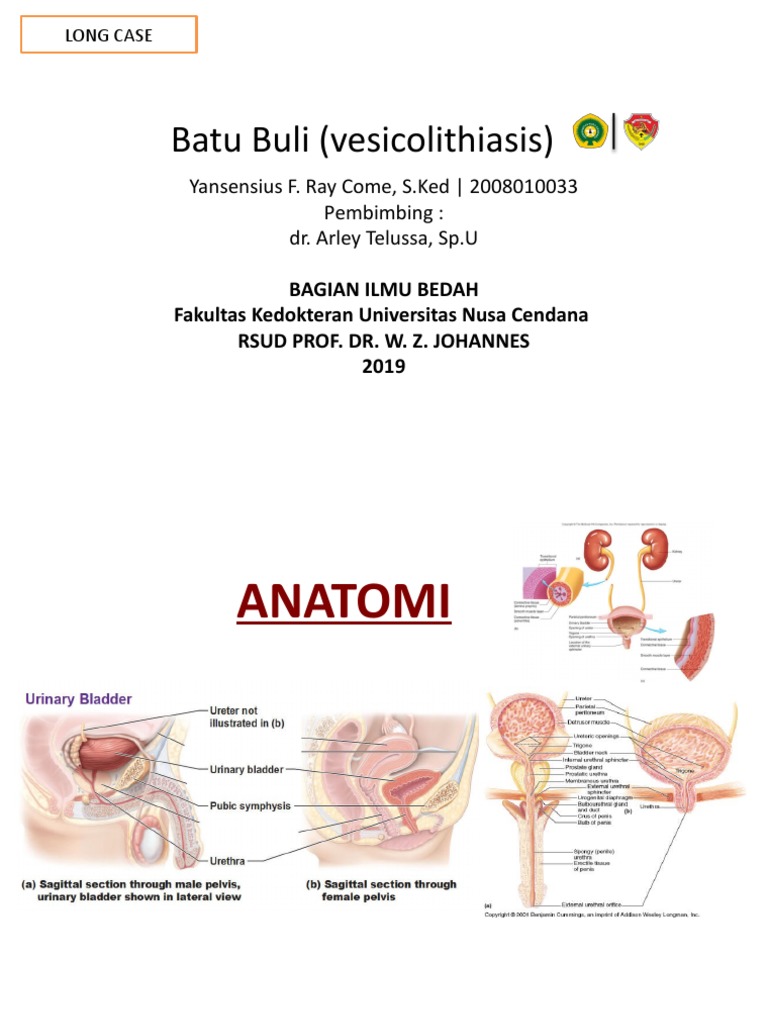 Long Case Vesicolithiasis | PDF