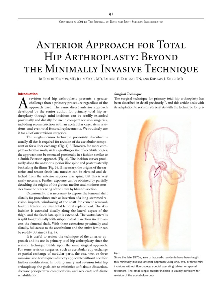 Anterior Approach For Total Hip Arthroplasty Beyond The Minimally ...