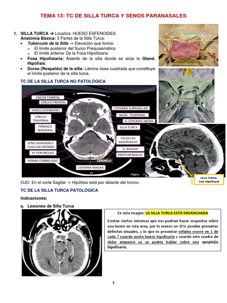 Tema 13 - Silla Turca y Senos Paranasales | PDF | Glándula pituitaria ...
