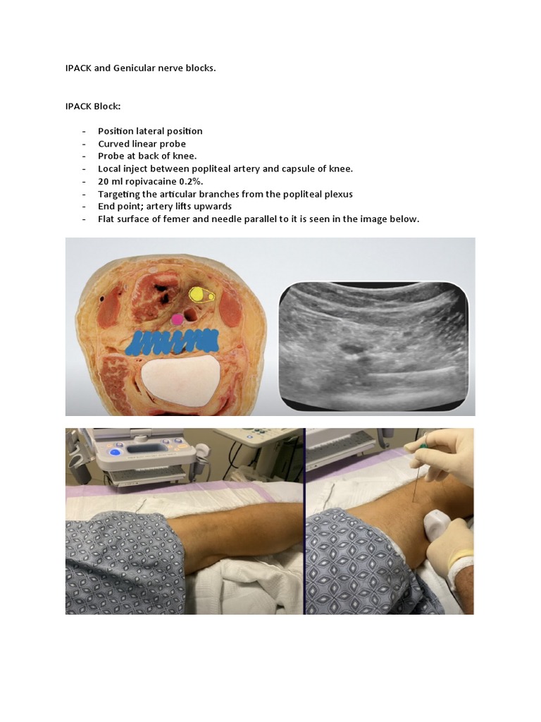 IPACK and Genicular Nerve Blocks | PDF
