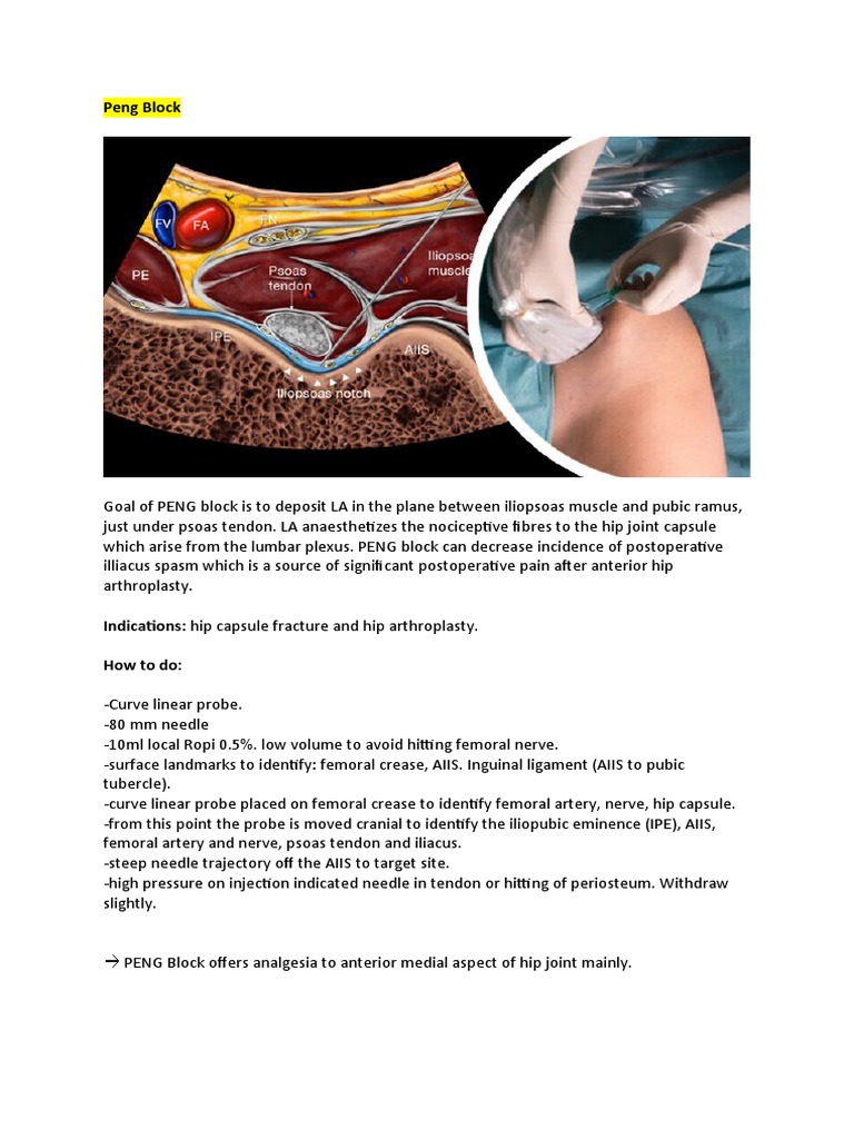 PENG Block: Anterior Hip Analgesia Guide | PDF