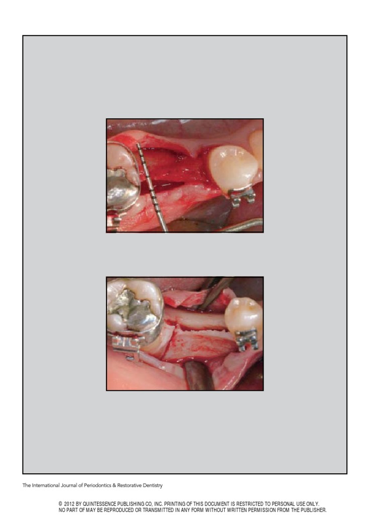 Rapid Orthodontics Post Ridge-Splitting | PDF | Dental Implant ...