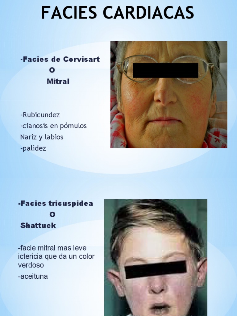 Facies Cardíacas y Cianosis en Patologías | PDF