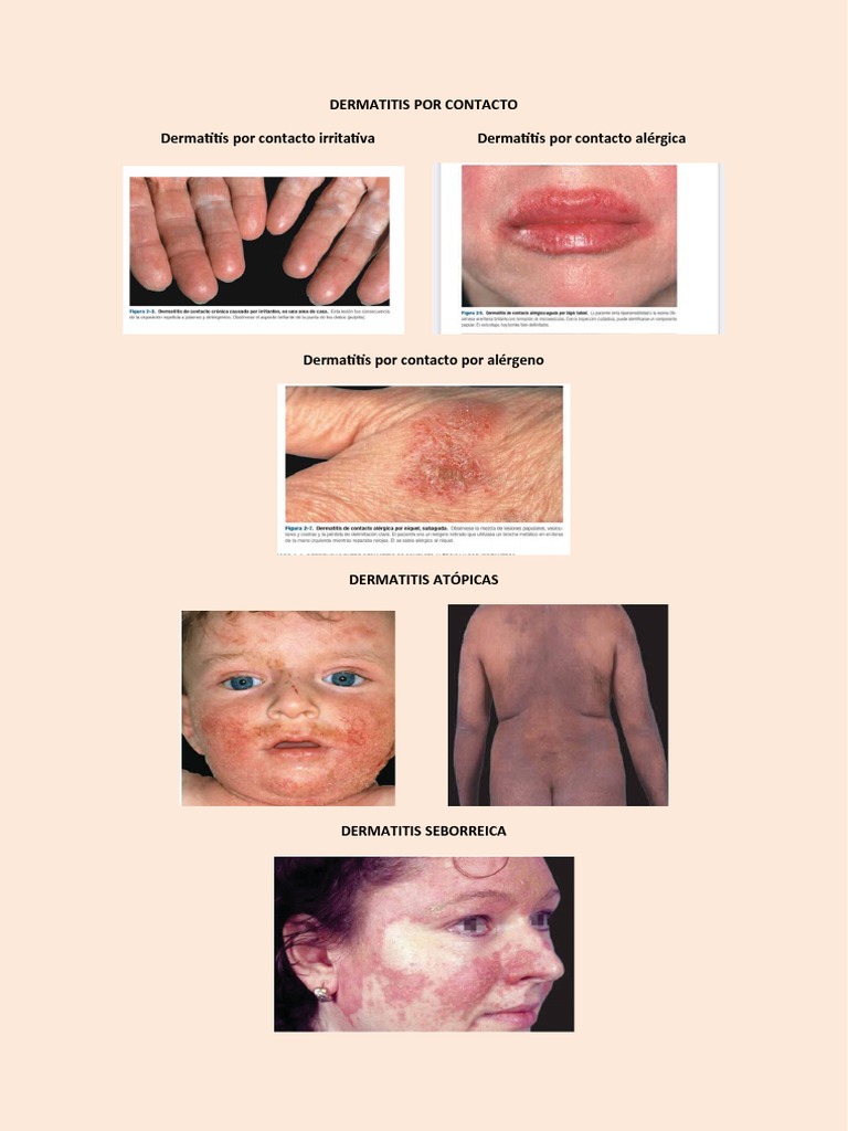 Dermatitis Por Contacto | PDF
