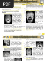 Engrosamiento mucoso en sinusitis maxilar | PDF | Enfermedades y ...