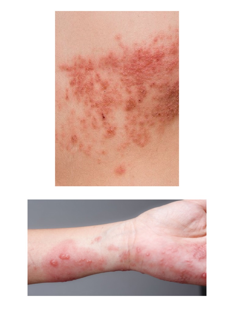 Gambar Skabies | PDF