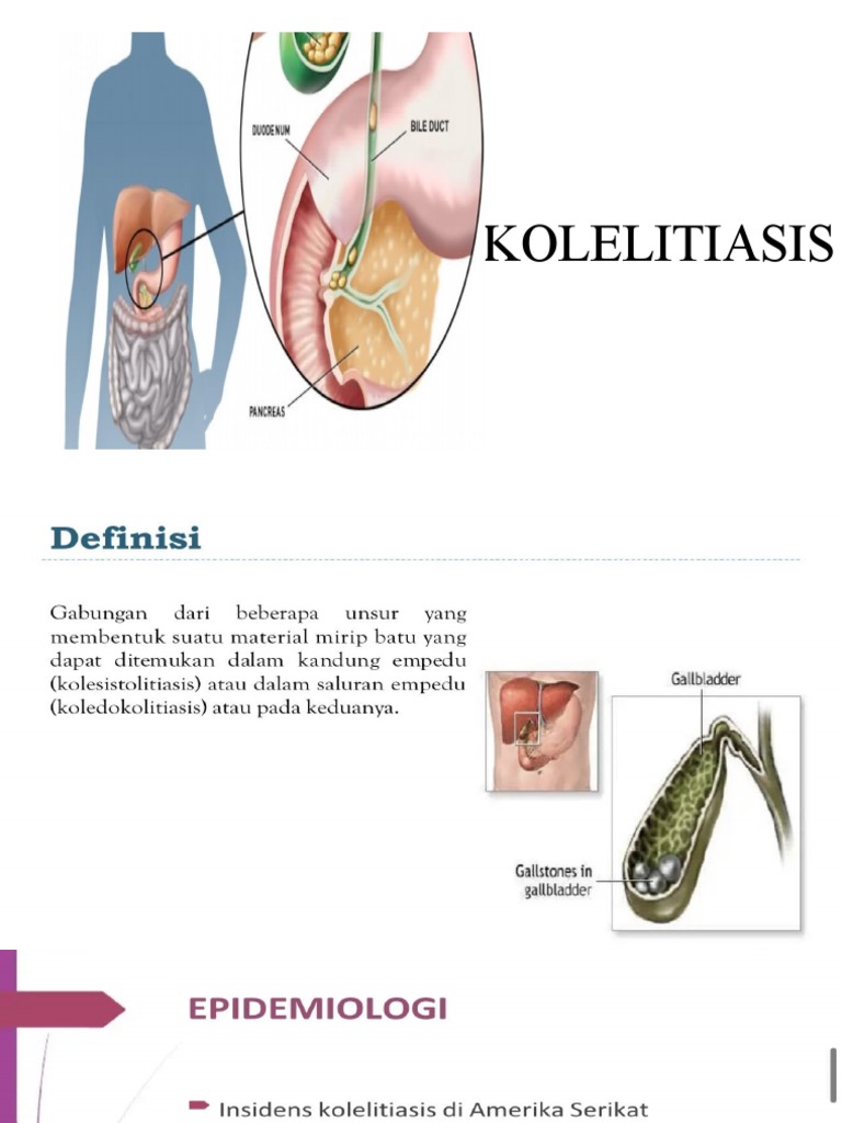 KOLELITIASIS | PDF