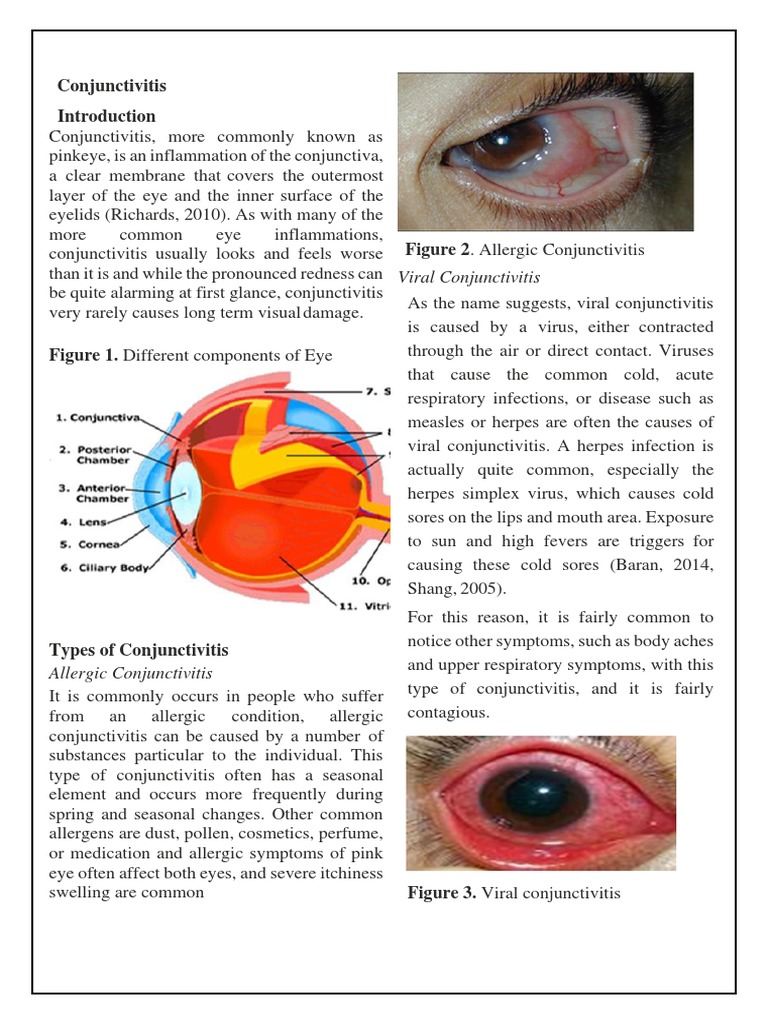 Conjunctivitis | PDF | Allergy | Clinical Medicine
