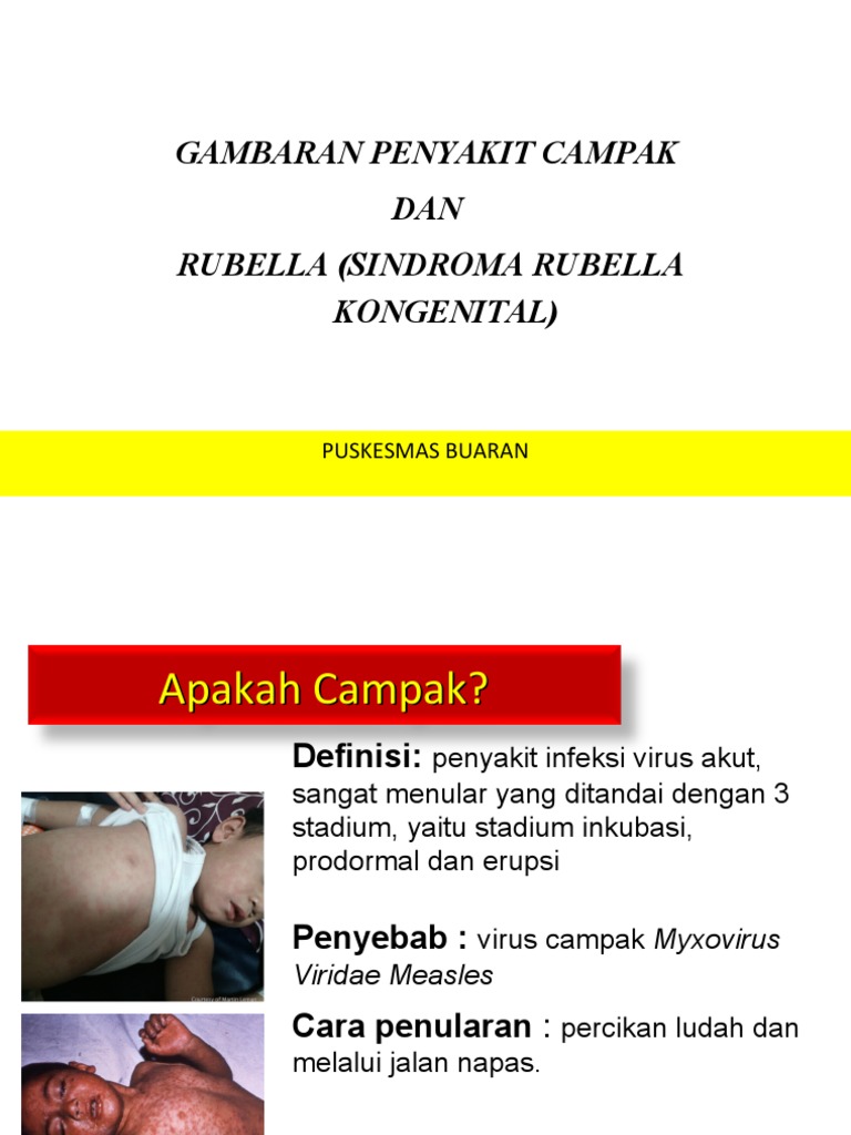 Campak Rubella | PDF