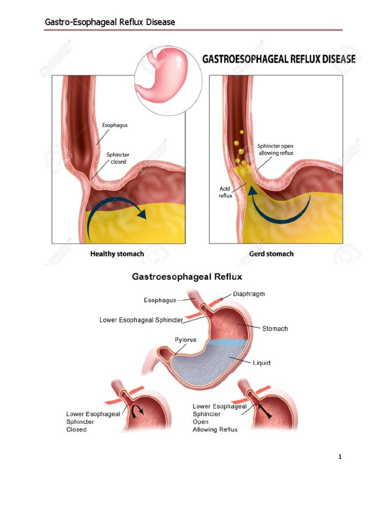 GERD | PDF | Gastroesophageal Reflux Disease | Esophagus